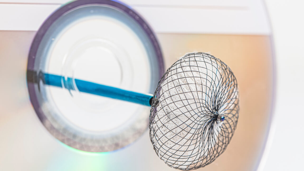 Long-Term Outcomes of PFO Closure | SOLACI