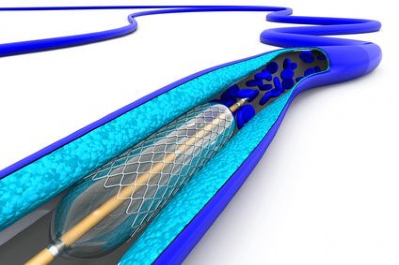 Everolimus eluting stent in total occlusions | SOLACI